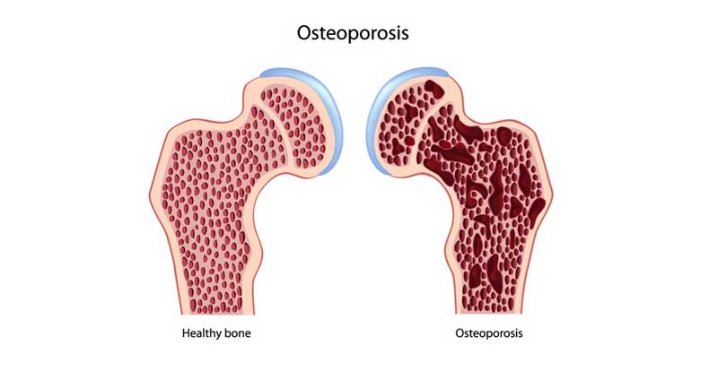 New Treatment Options for Brittle Bone Disease
